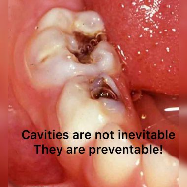 What are cavities?