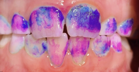 The Plaque Detective: Unveiling Oral Health Secrets with Disclosing ...